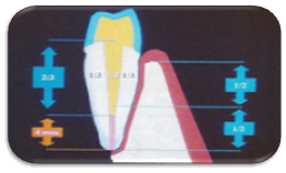 Odontologia: Retentores Intra-radiculares