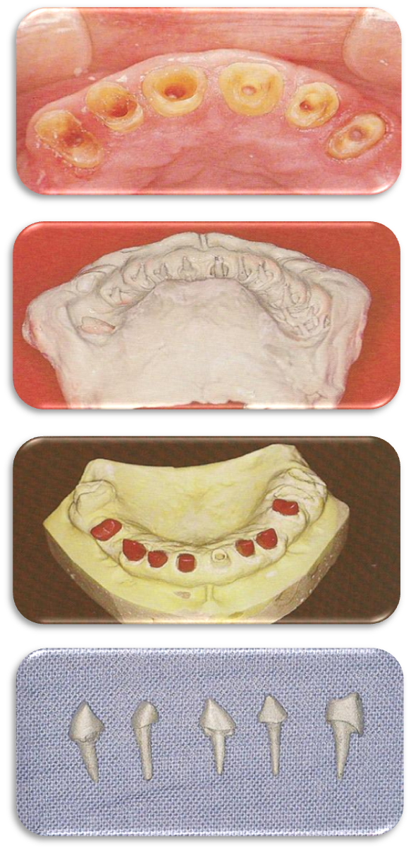 Odontologia: Retentores Intra-radiculares