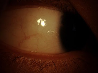 Sonoran Desert Eye Center: BITOT'S SPOT