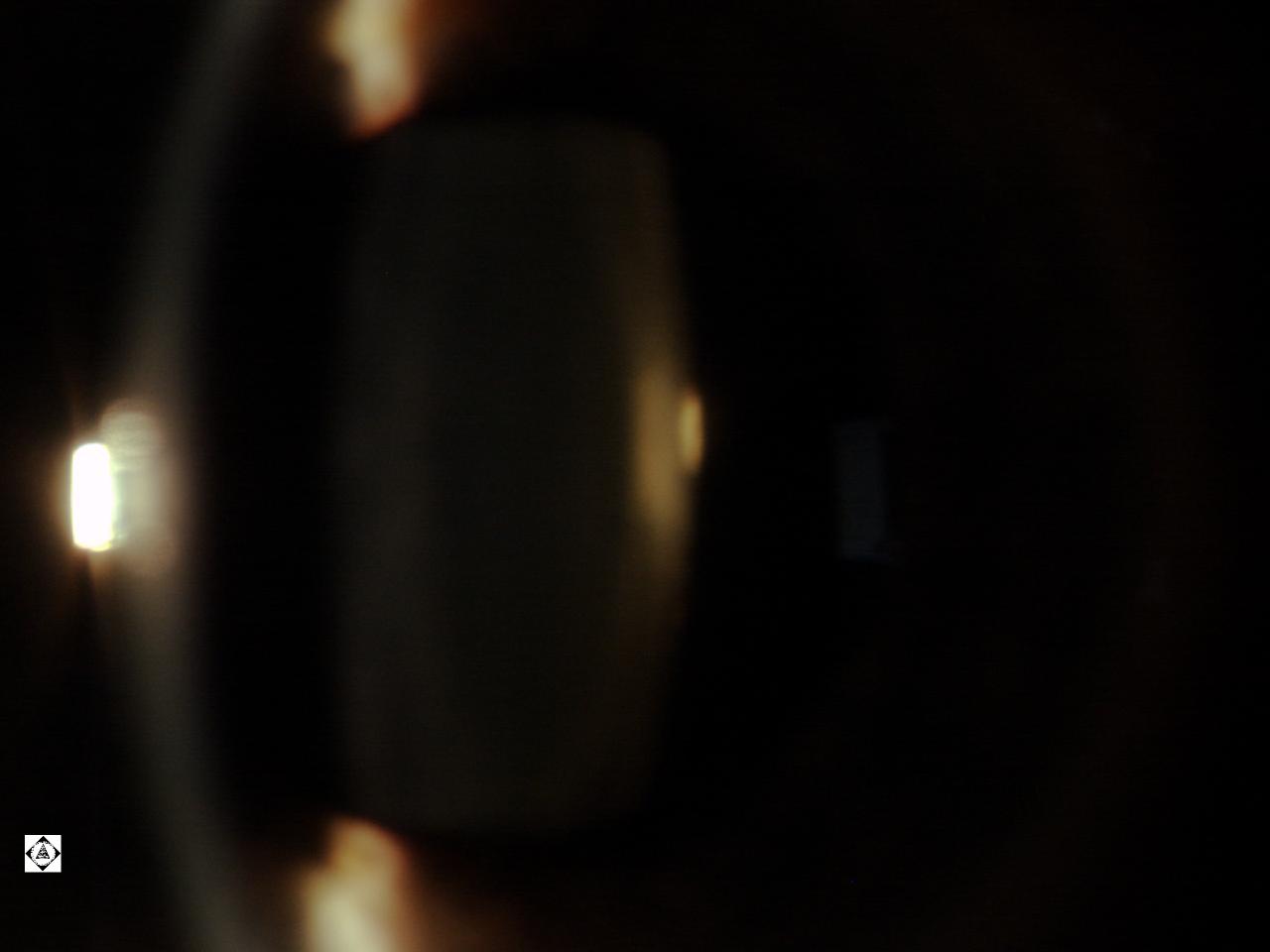 Normal Eye Lens