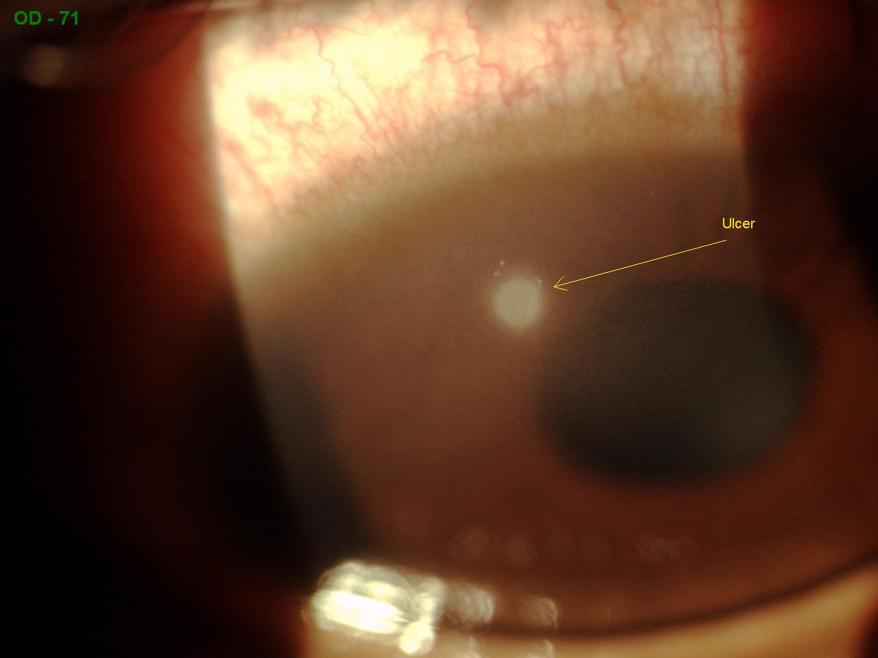 Sonoran Desert Eye Center: CORNEAL ULCER
