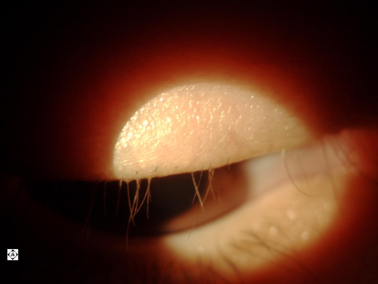 Sonoran Desert Eye Center: HABITUAL PULLING OF EYELASHES