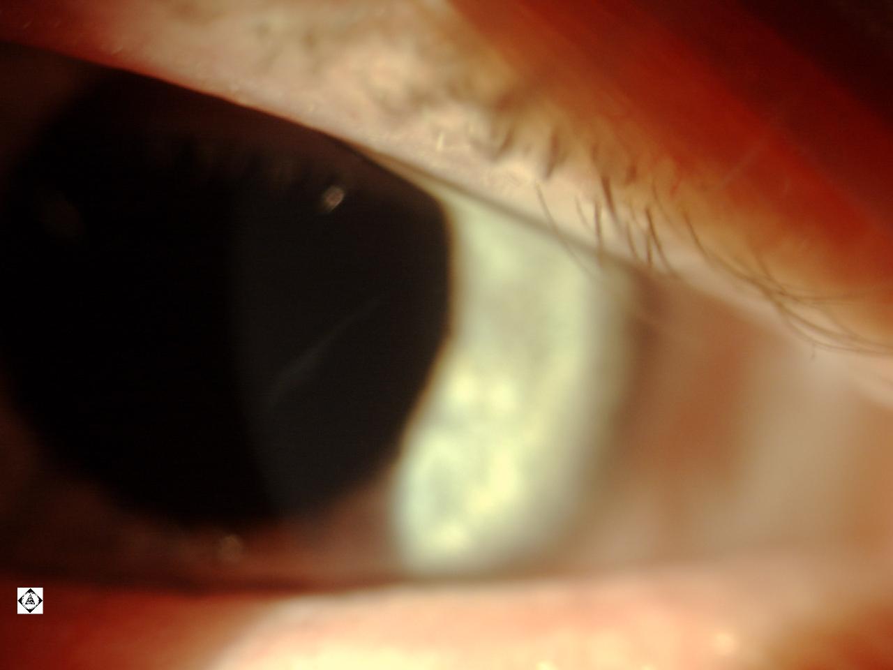 Sonoran Desert Eye Center: Cornea Scar
