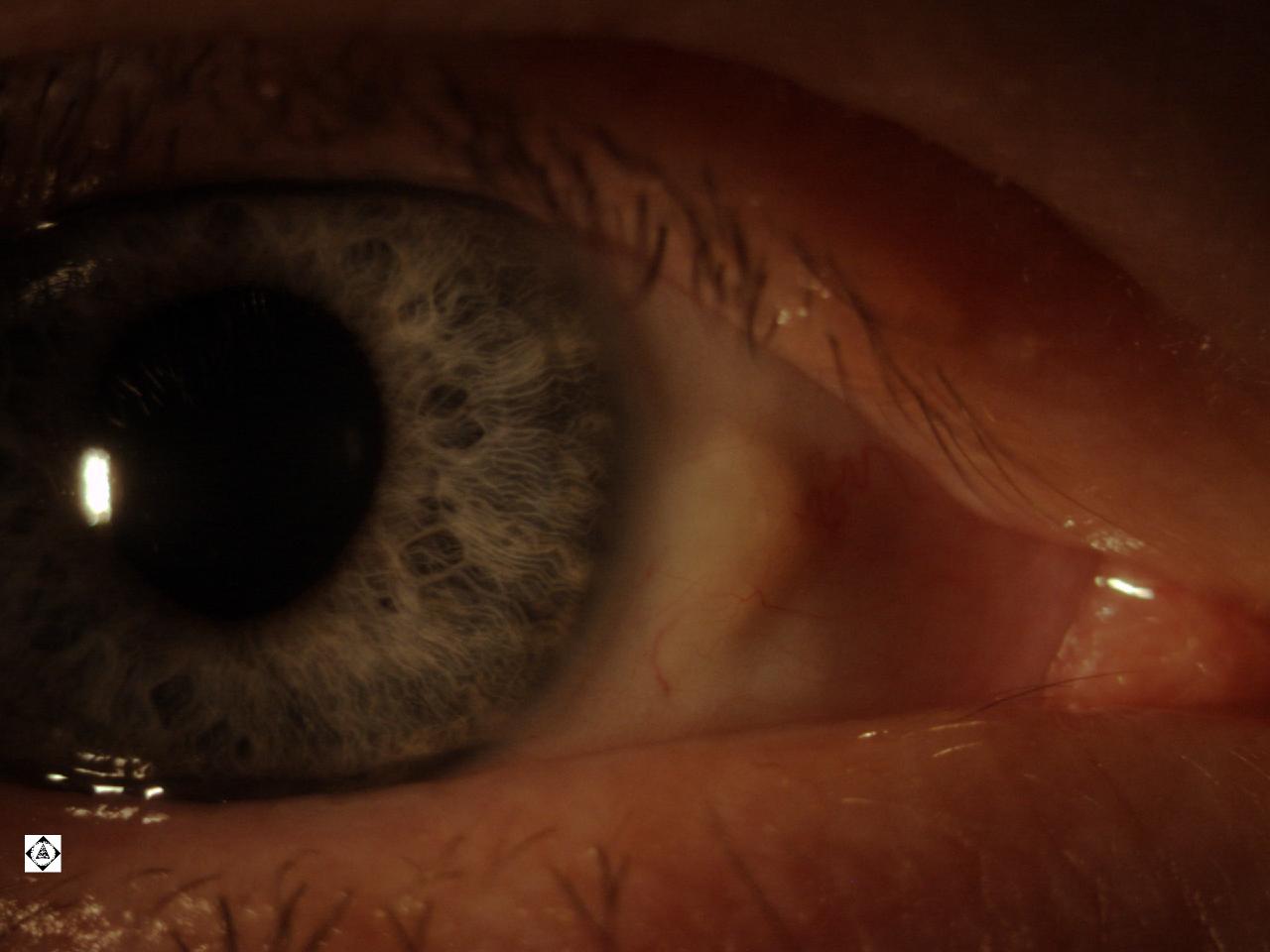 Sonoran Desert Eye Center: There's a Bump on My Eye!