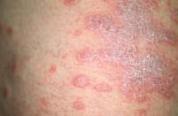 Rash Hepatitis C /Lichen planus /Photos
