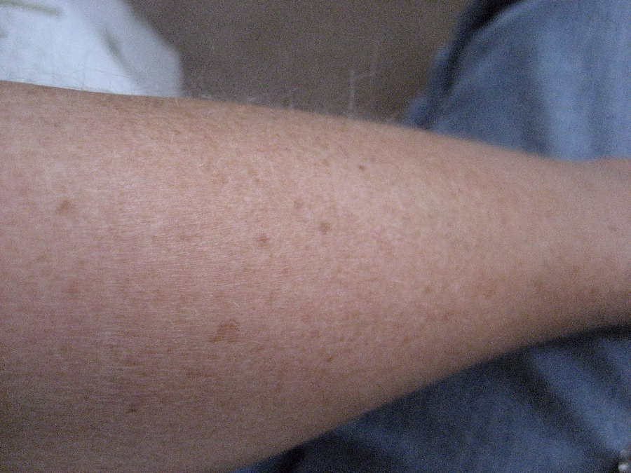 Chemical Peels for Acne and Anti Aging: TCA Peel Arms - Day 0