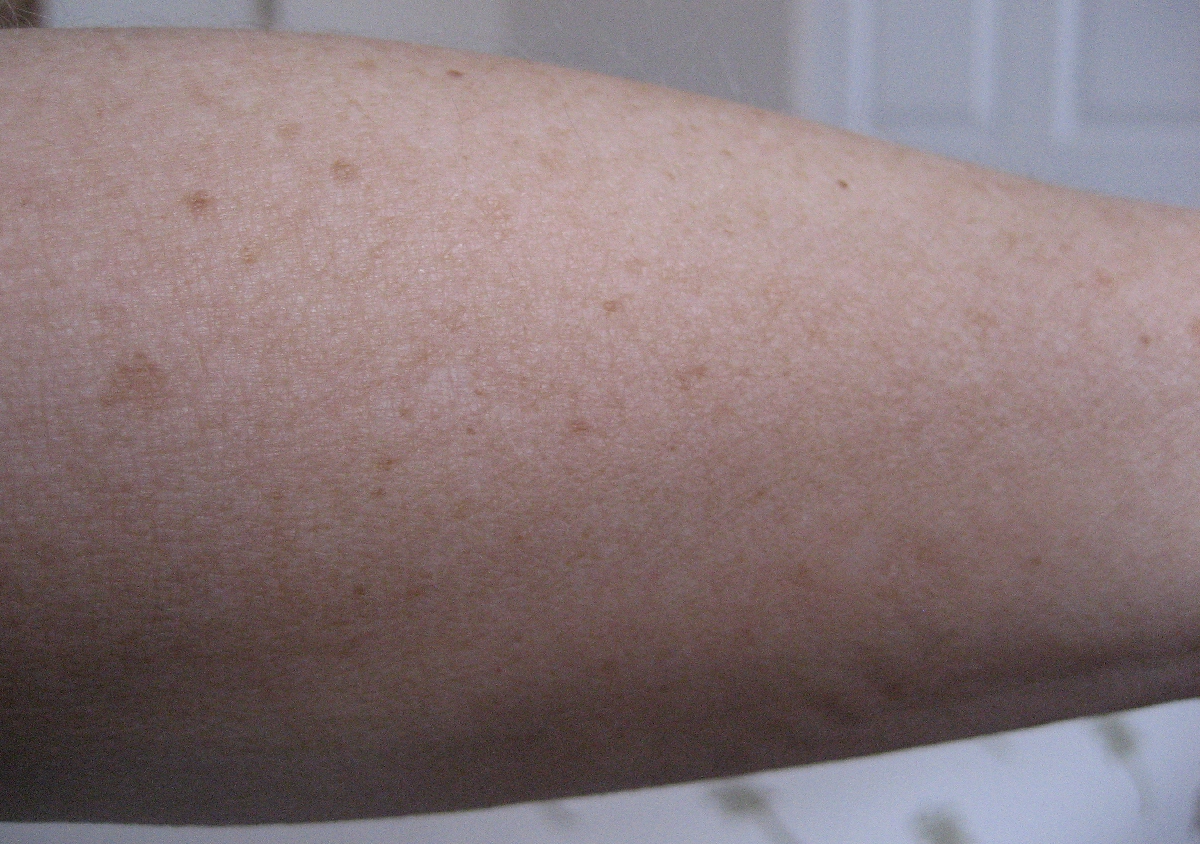 Chemical Peels for Acne and Anti Aging: TCA 50% Chemical peel - before ...