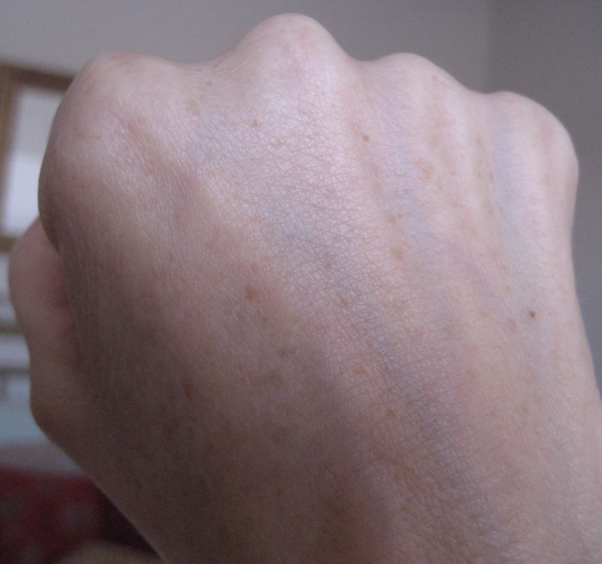 Chemical Peels for Acne and Anti Aging: Spot treatment for hands ...