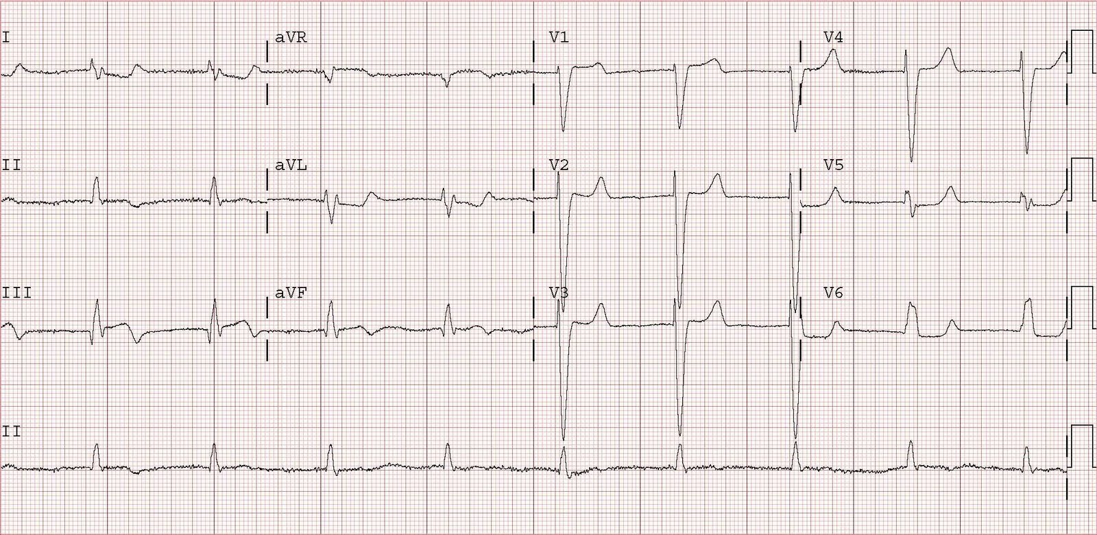 Dr. Smith's ECG Blog: April 2010