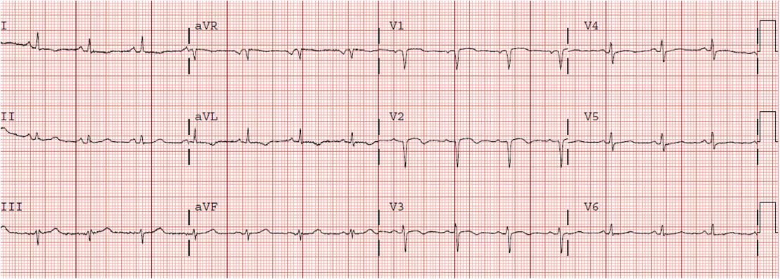 Dr. Smith's ECG Blog: Progression of Anterior STEMI with RBBB and ...