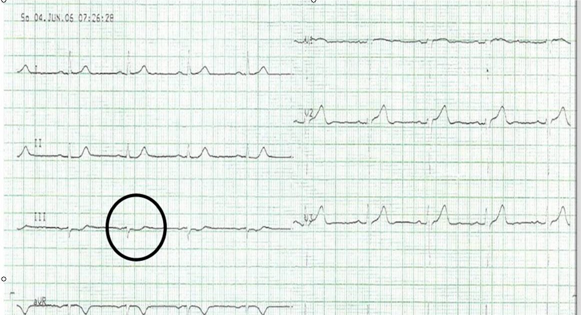 Dr. Smith's ECG Blog: ST depression limited to Inferior leads is ...