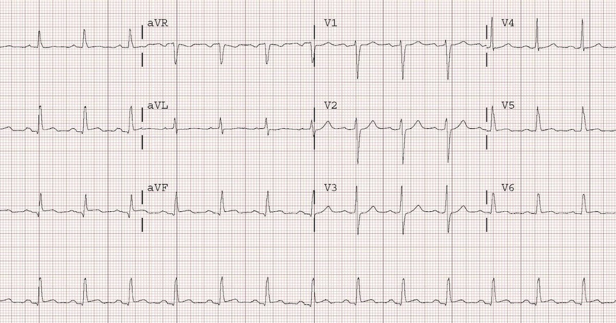 Dr. Smith's ECG Blog: Circumflex Occlusion May be Subtle or Invisible ...