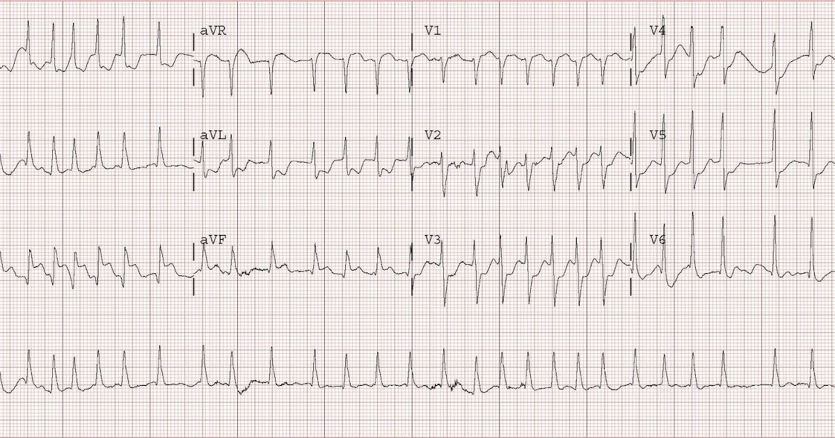 Dr. Smith's ECG Blog: Atrial Fibrillation with RVR and Inferoposterior ...