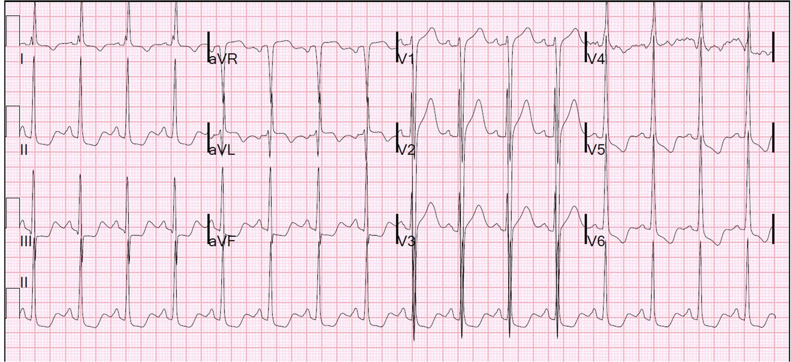 Dr. Smith's ECG Blog: Cardiac Arrest, acute ST elevation and depression ...