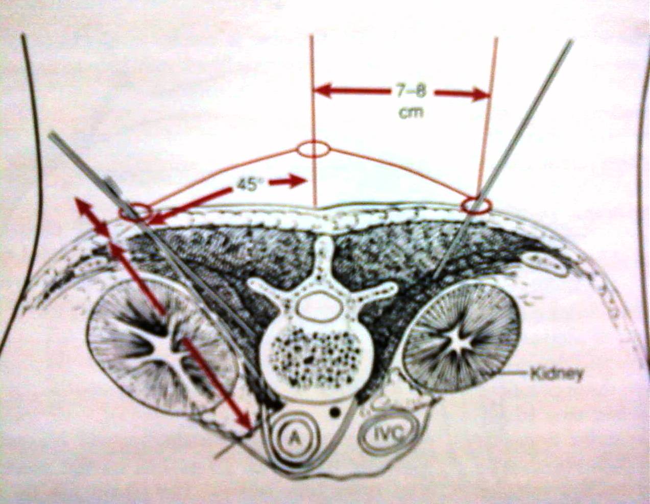 Anaesthesia Today Celiac Plexus Block