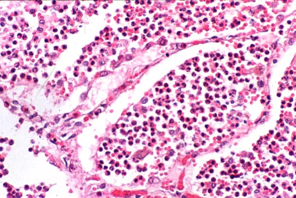 patologiaenblog: NECROSIS