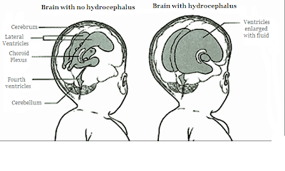 and the greatest of these is love: Hydrocephalus 101