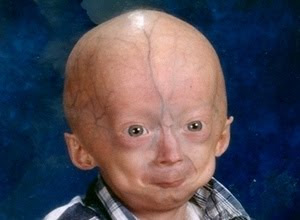 Life in a fast forward mode..........: (Progeria)