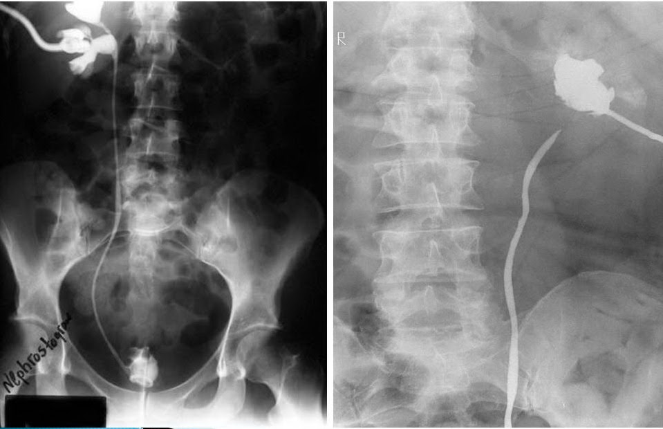 Teknik Radiografi Antegrade Pyelography (APG) ~ Catatan Radiograf