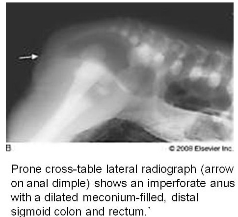 RADIOGRAFER WORLD: Teknik Radiografi Pada Kasus Atresia Ani