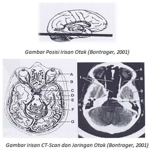 Teknik Pemeriksaan CT-Scan Kepala ~ Catatan Radiograf