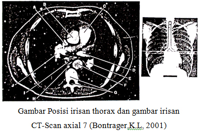 LAMPIRAN. Citra pertama yang diperoleh dari CT-scan Thorax adalah ...
