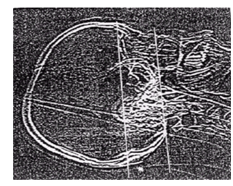 Teknik Pemeriksaan CT-Scan Mastoid ~ Catatan Radiograf