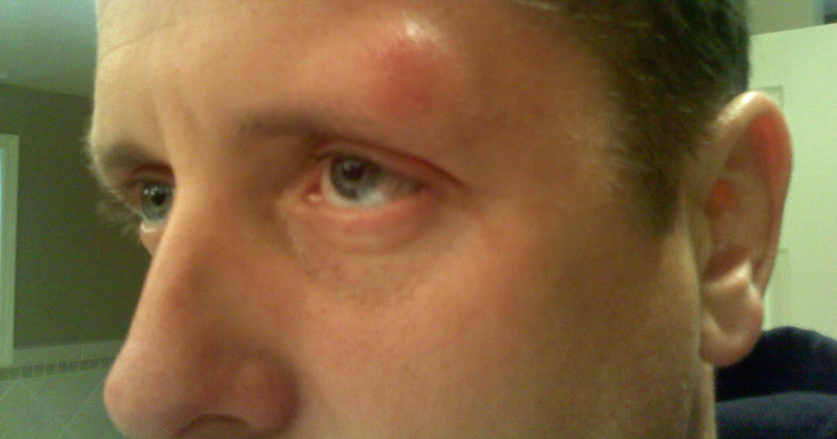 shingles on my face: Day 1