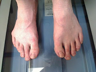 Patrick's Ortho Blog: Griechische Fussform