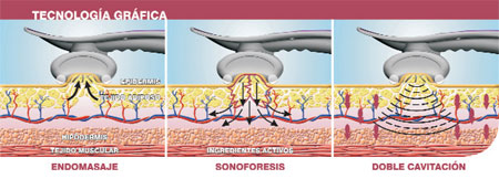 Laser Natura Valdepeñas: Tratamiento de Cavitación
