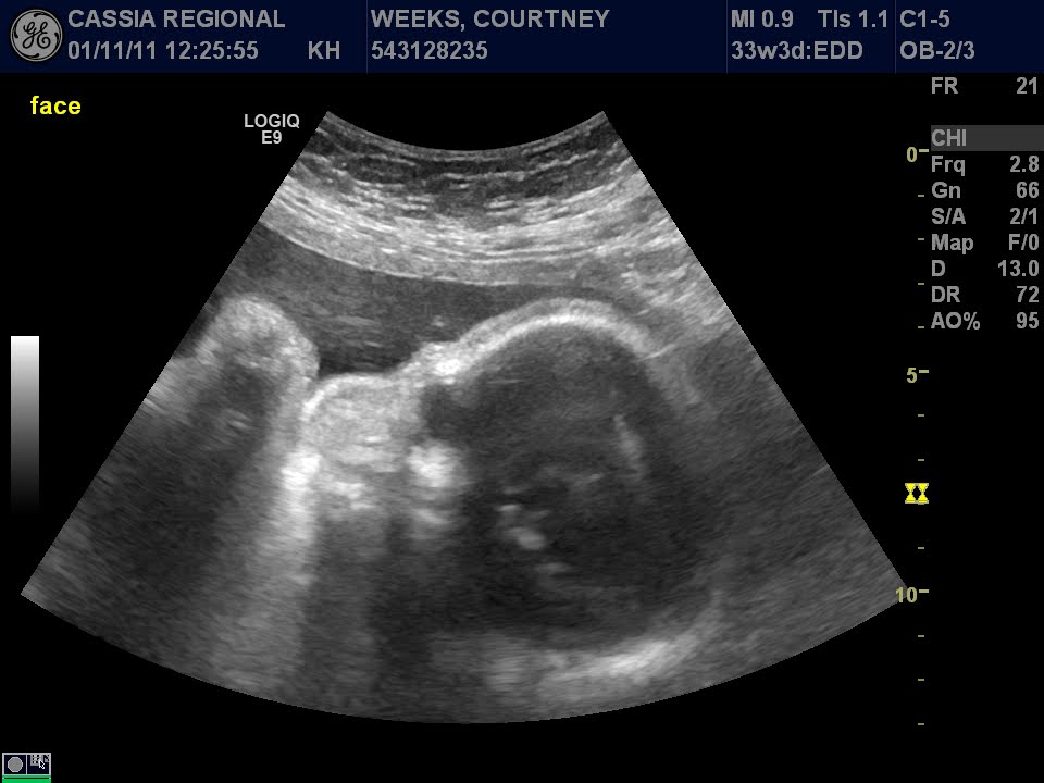 Jason and Courtney: Riley's 33 week ultrasound