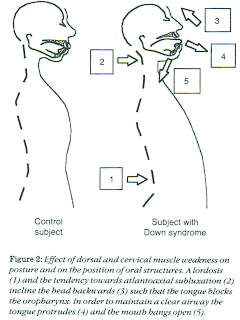 32 Gems: DOWN'S SYNDROME / MONGOLIANISM / MONGOLISM / TRISOMY 21