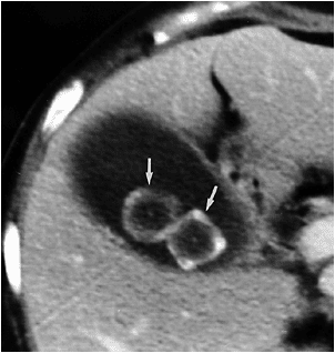 RadiologySpirit: facetted gall bladder stone