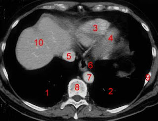 RadiologySpirit: HOW TO READ CT ABDOMEN