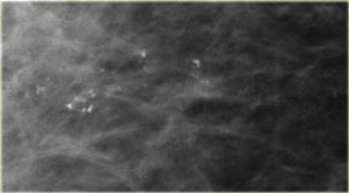 RadiologySpirit: BI-RADS AND CALCIFICATION(FIGURES)