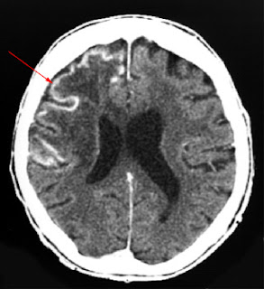 RadiologySpirit: Cerebral Stroke