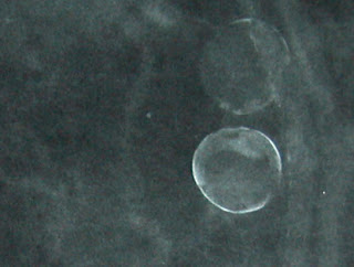 RadiologySpirit: BI-RADS AND CALCIFICATION(FIGURES 2)