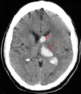 RadiologySpirit: Cerebral Stroke