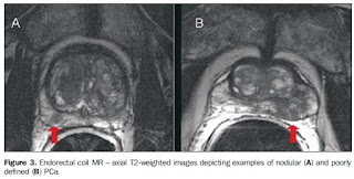 RadiologySpirit: MRI OF PROSTATE