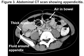 RadiologySpirit: APPENDICITIS