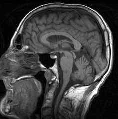 RadiologySpirit: Thornwaldt Cyst