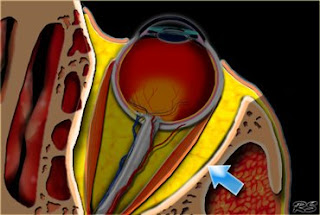 RadiologySpirit: Orbital Lesions