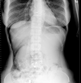 RadiologySpirit: Extraluminal Intra-Abdominal Gas