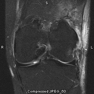 RadiologySpirit: Lateral Collateral Ligament Tear