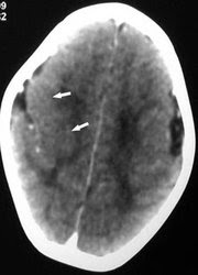 RadiologySpirit: Lissencephaly
