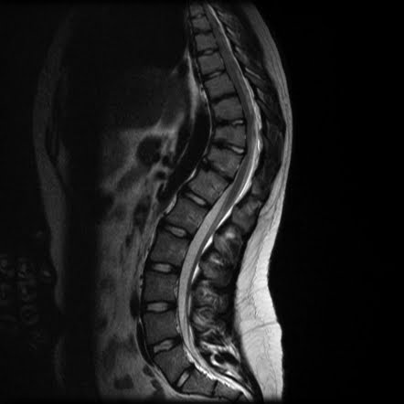 RadiologySpirit: kyphosis