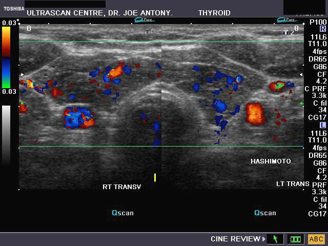 Normal Thyroid Ultrasound