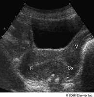 Ultrasound Images: Retroverted Uterus Ultrasound Images