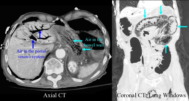 RadiologySpirit: Bowel Ischemia with Pneumatosis Coli and Portal Venous ...