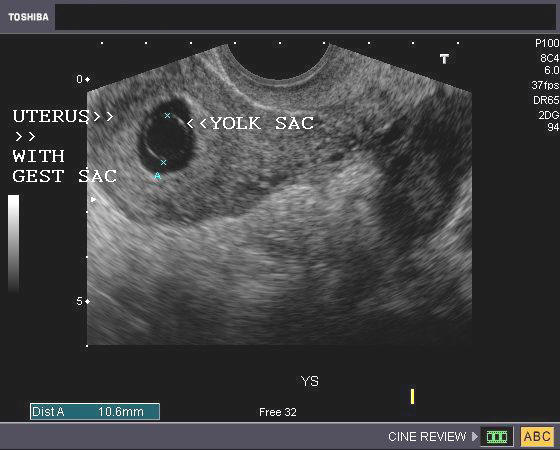 Abnormal Yolk Sac Ultrasound